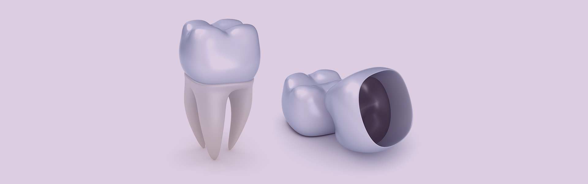 Dental Crowns in West Edmonton, AB | Donsdale Dental Clinic